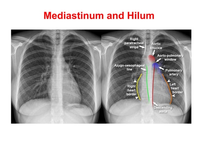 CHEST XRAYS STEP BY STEP APPROACH,,.pptx
