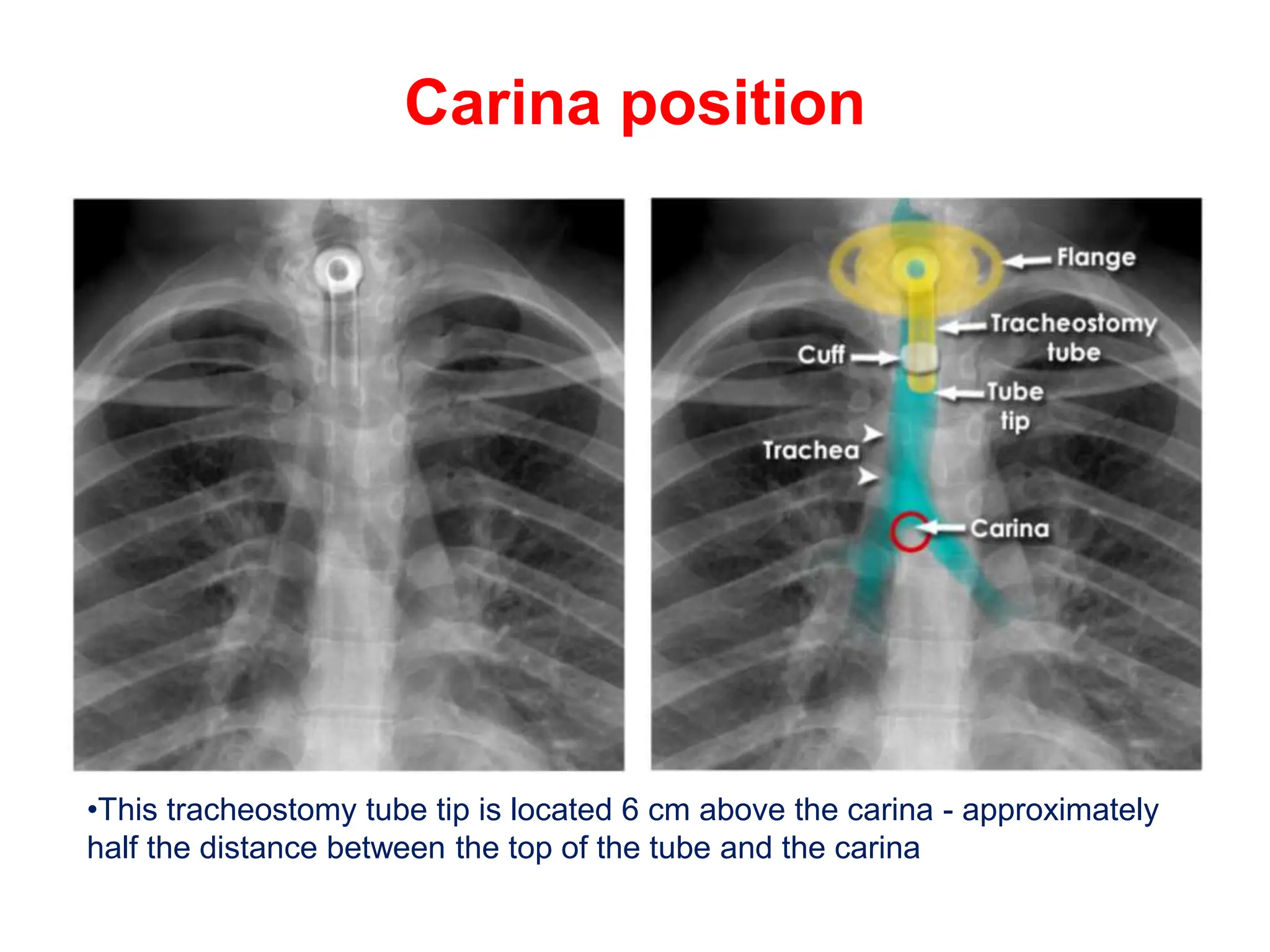CHEST XRAY TUBES.pptx,,,,,,,,,,,,,,,,,,, | PPTX