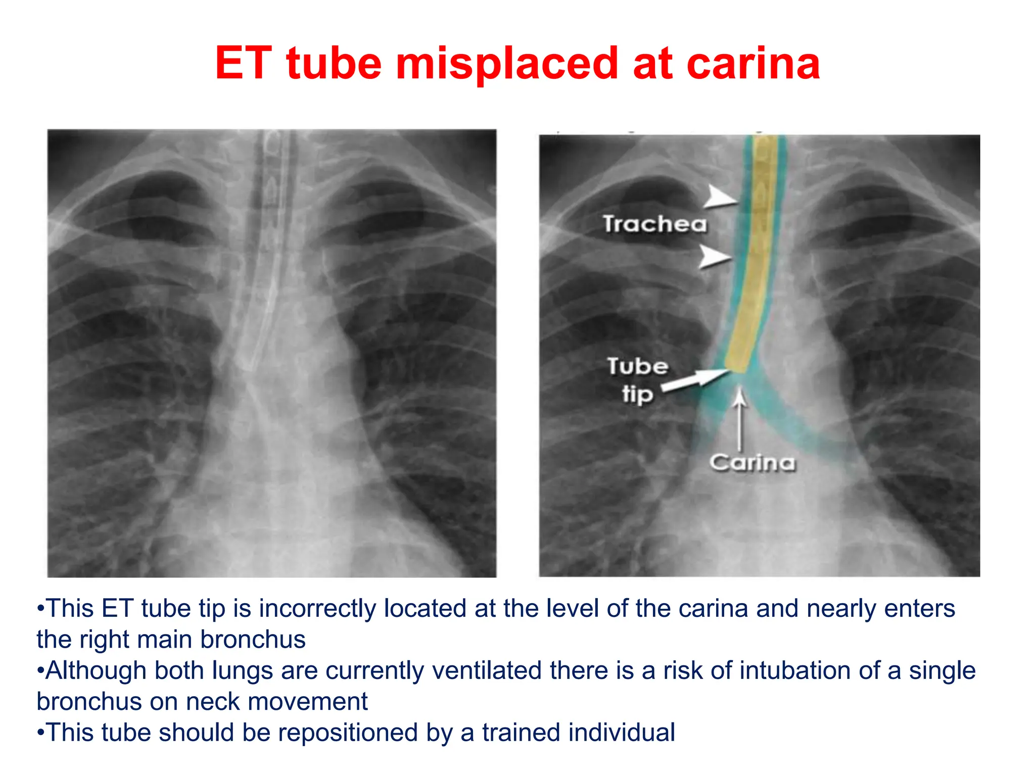 CHEST XRAY TUBES.pptx,,,,,,,,,,,,,,,,,,, | PPTX