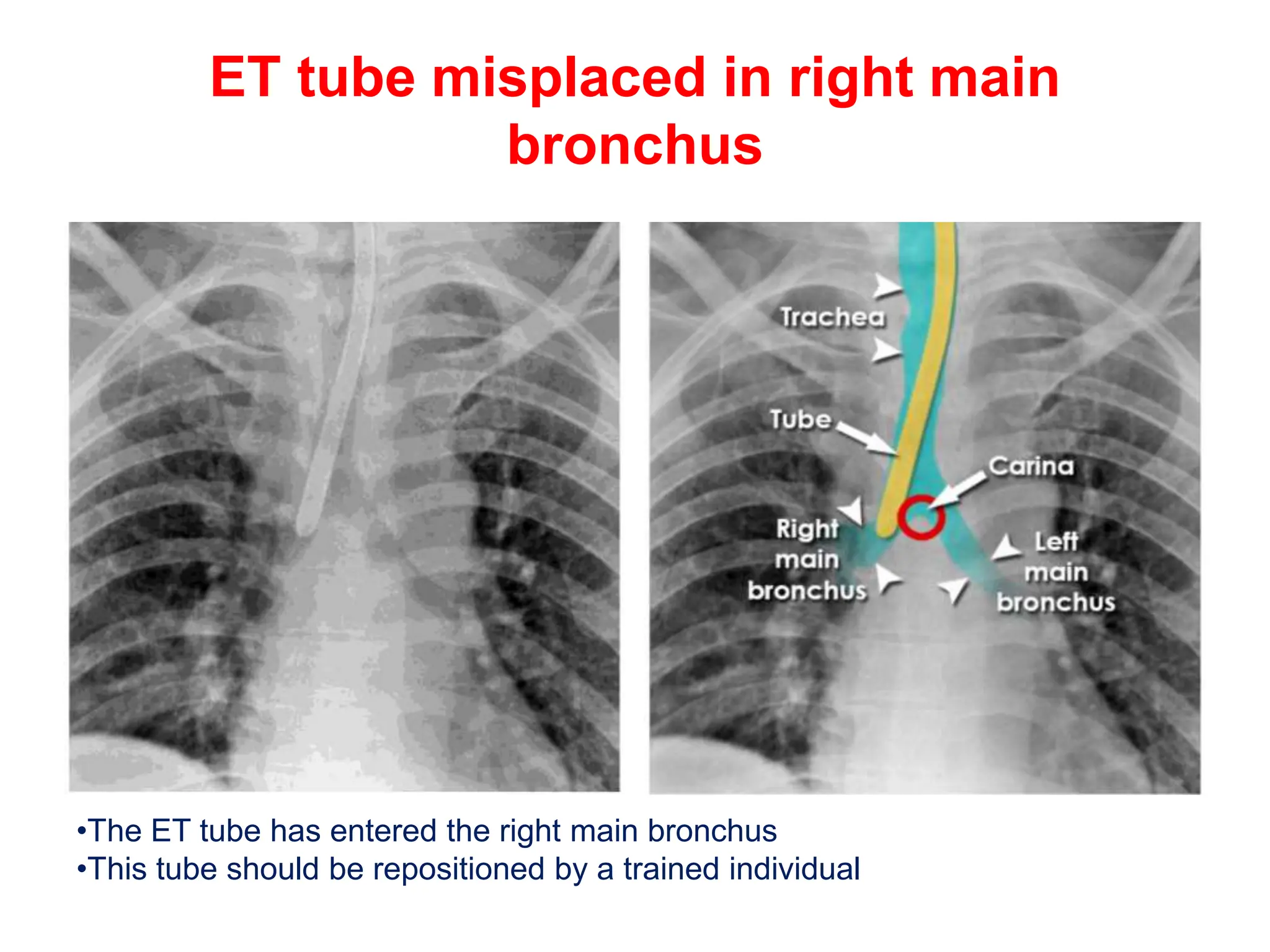 CHEST XRAY TUBES.pptx,,,,,,,,,,,,,,,,,,, | PPTX