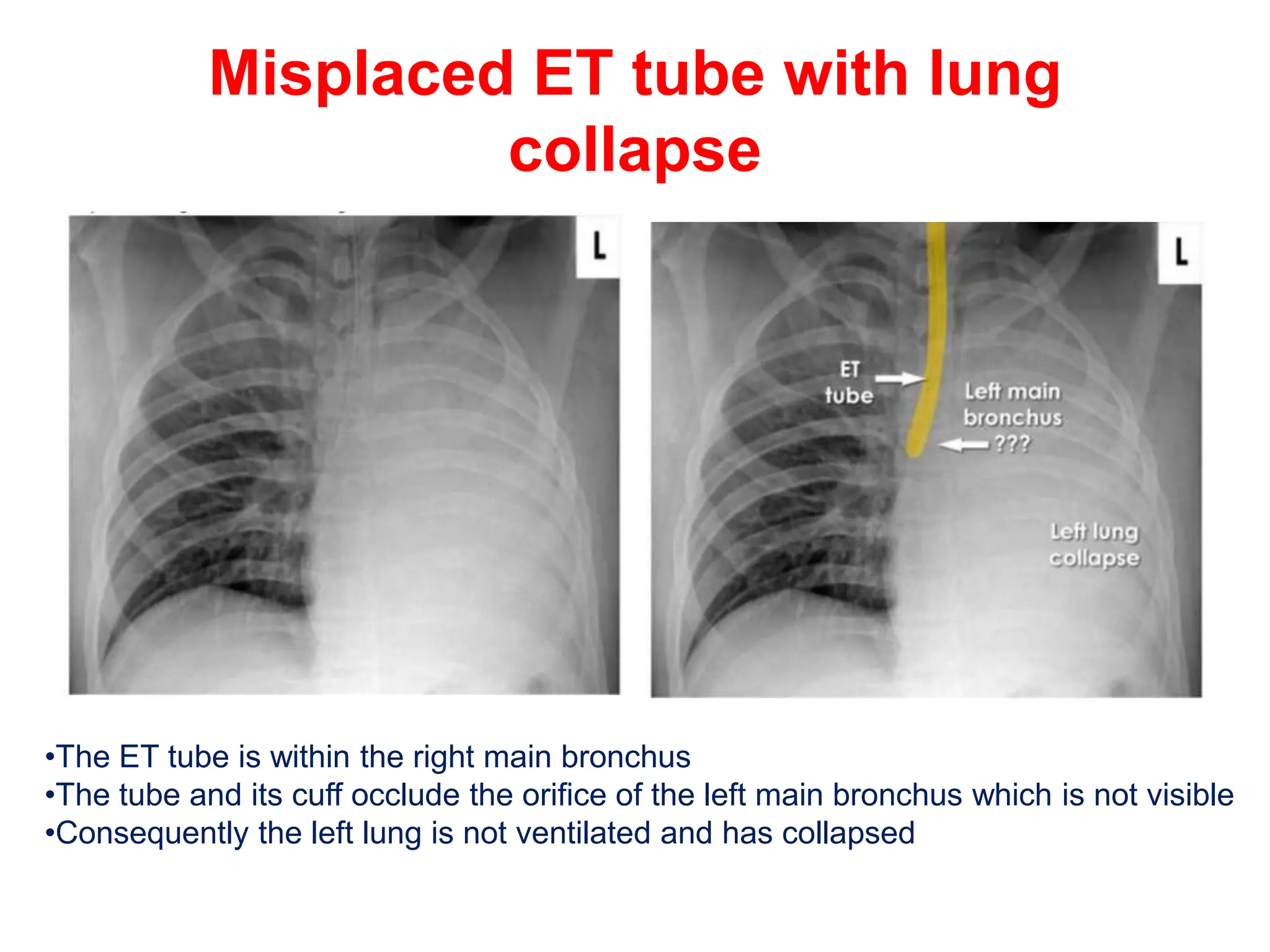 CHEST XRAY TUBES.pptx,,,,,,,,,,,,,,,,,,, | PPTX