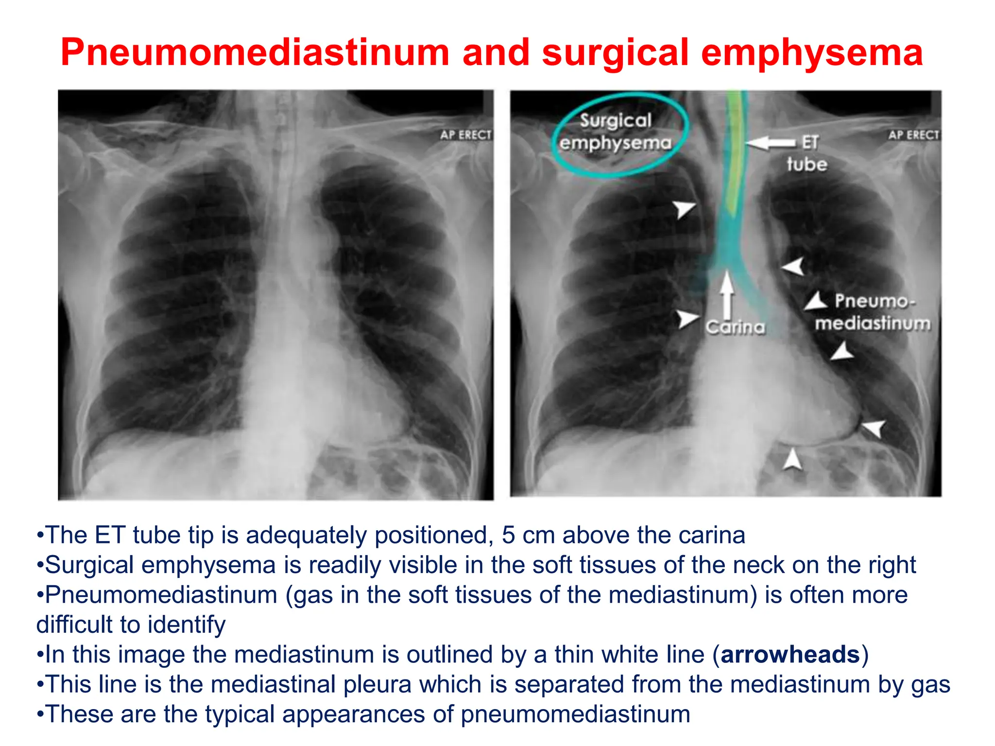CHEST XRAY TUBES.pptx,,,,,,,,,,,,,,,,,,, | PPTX