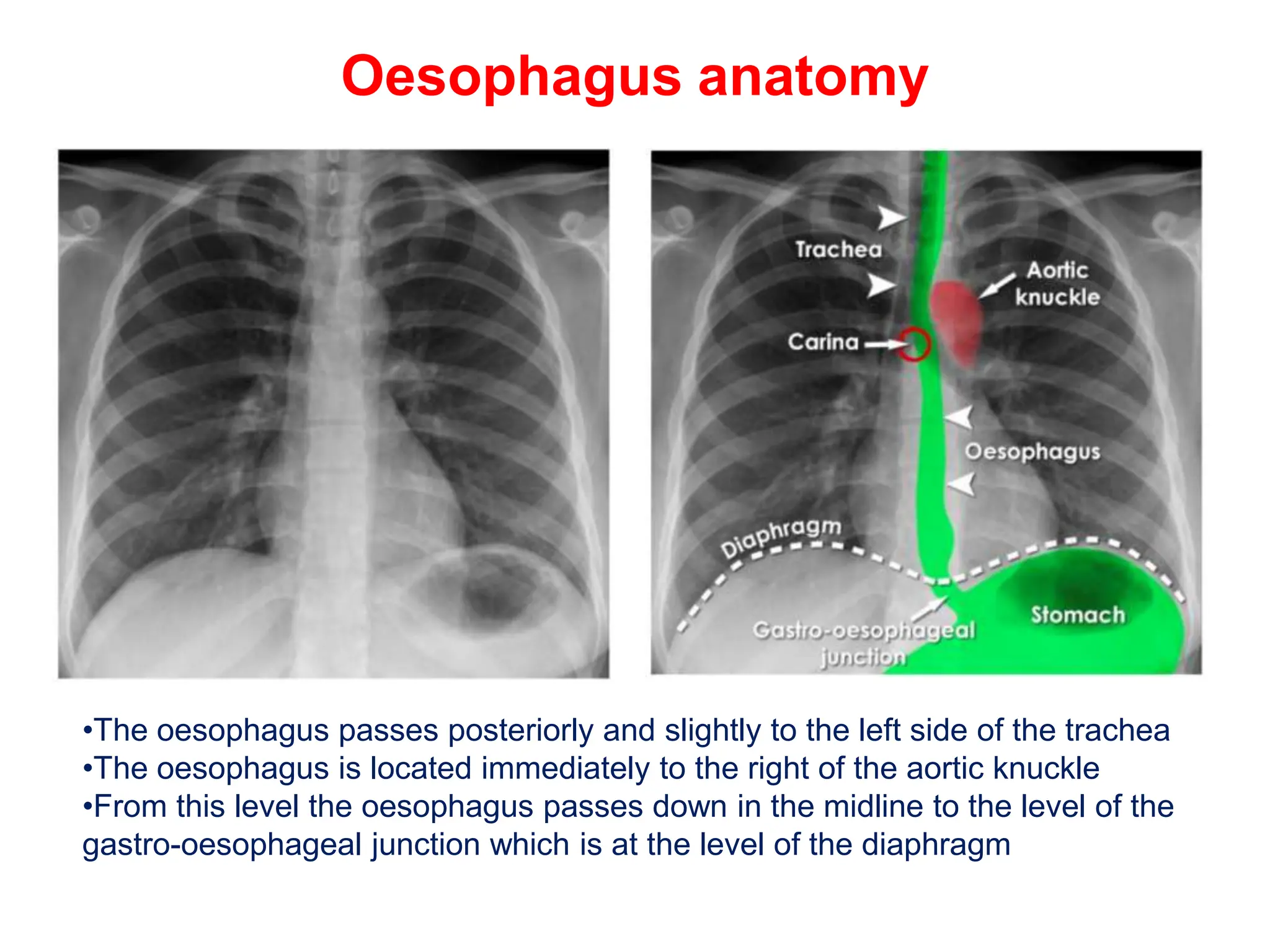 CHEST XRAY TUBES.pptx,,,,,,,,,,,,,,,,,,, | PPTX