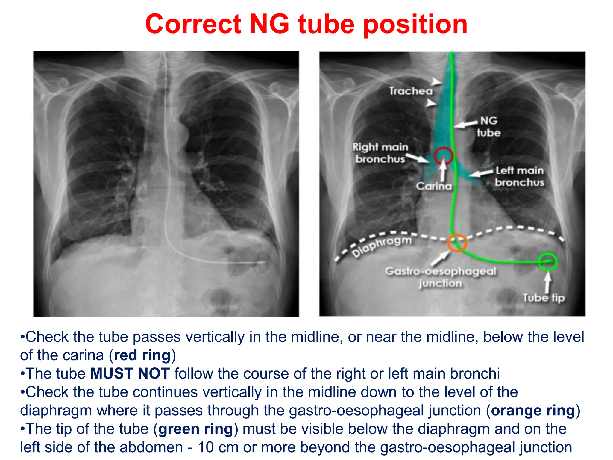 CHEST XRAY TUBES.pptx,,,,,,,,,,,,,,,,,,, | PPTX
