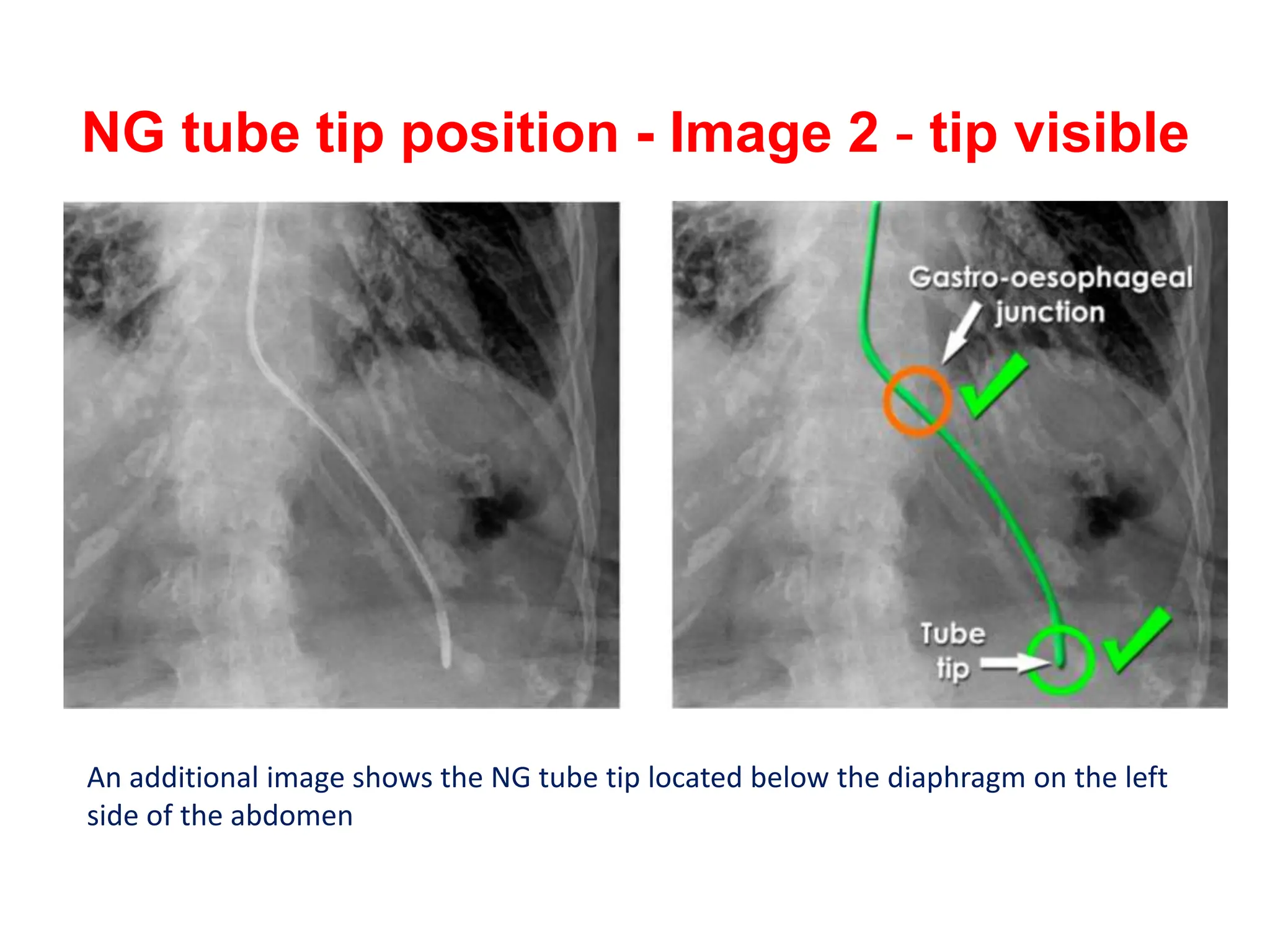 CHEST XRAY TUBES.pptx,,,,,,,,,,,,,,,,,,, | PPTX
