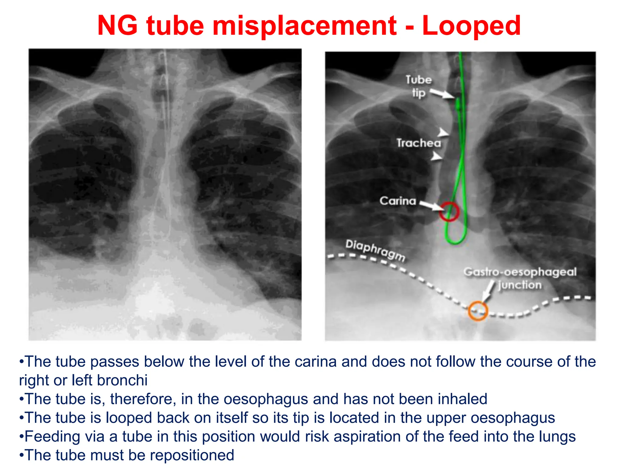 CHEST XRAY TUBES.pptx,,,,,,,,,,,,,,,,,,, | PPTX