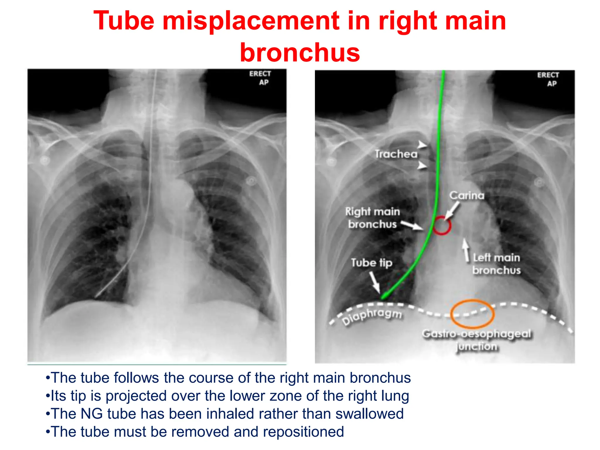 CHEST XRAY TUBES.pptx,,,,,,,,,,,,,,,,,,, | PPTX