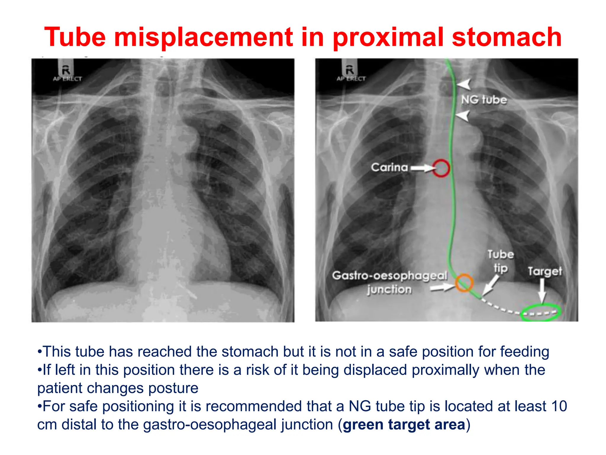 CHEST XRAY TUBES.pptx,,,,,,,,,,,,,,,,,,, | PPTX