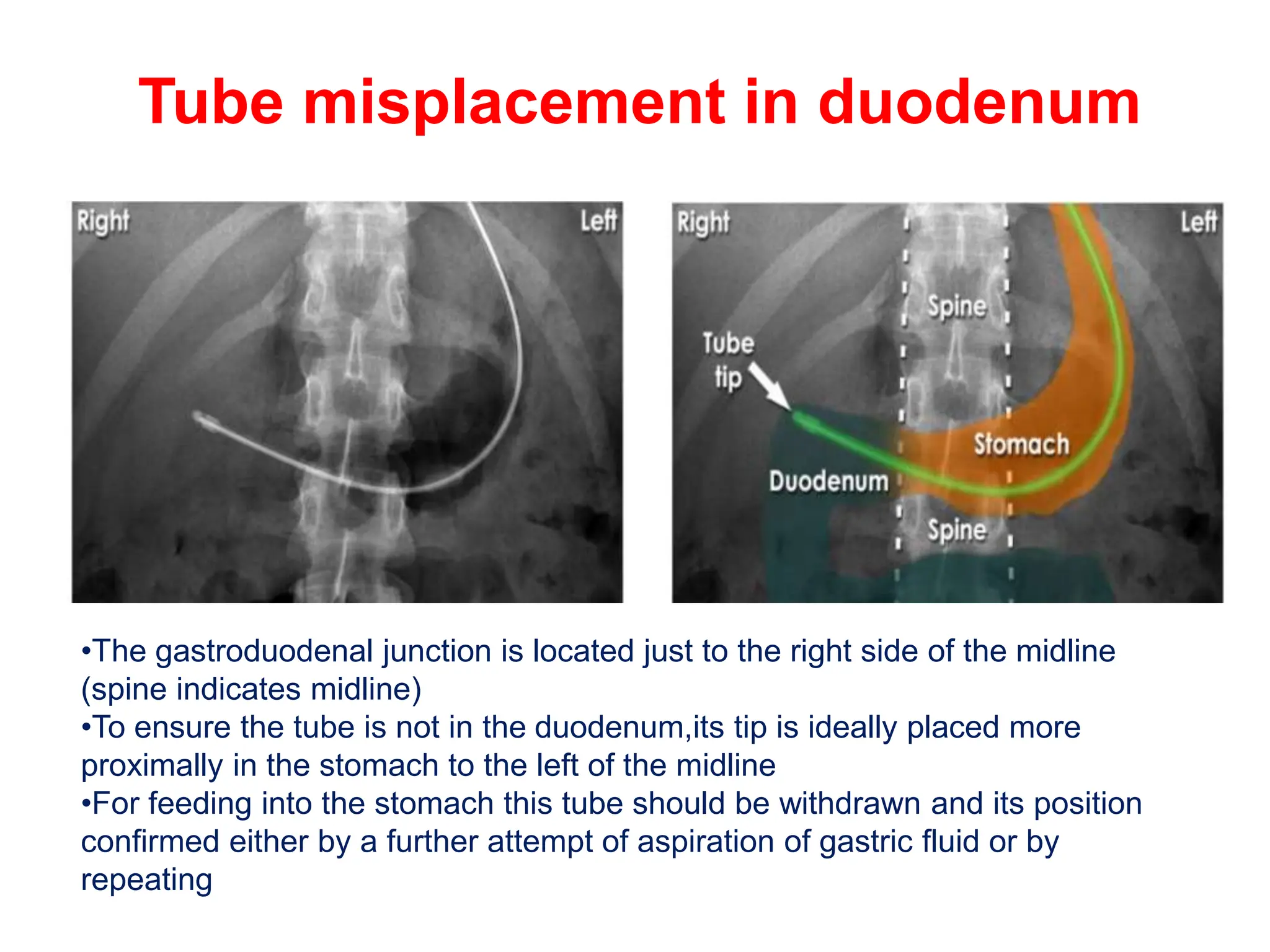 CHEST XRAY TUBES.pptx,,,,,,,,,,,,,,,,,,, | PPTX