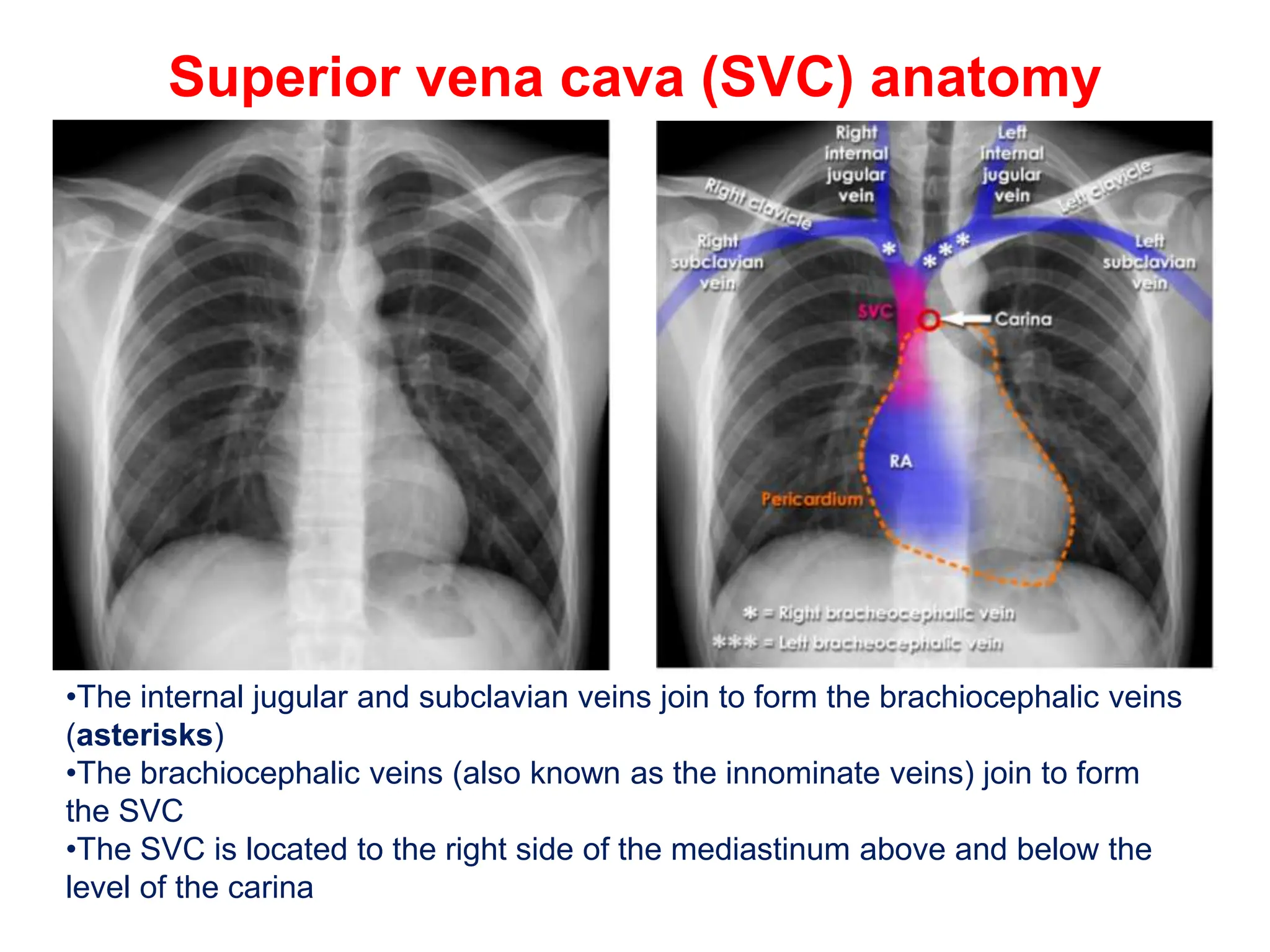 CHEST XRAY TUBES.pptx,,,,,,,,,,,,,,,,,,, | PPTX