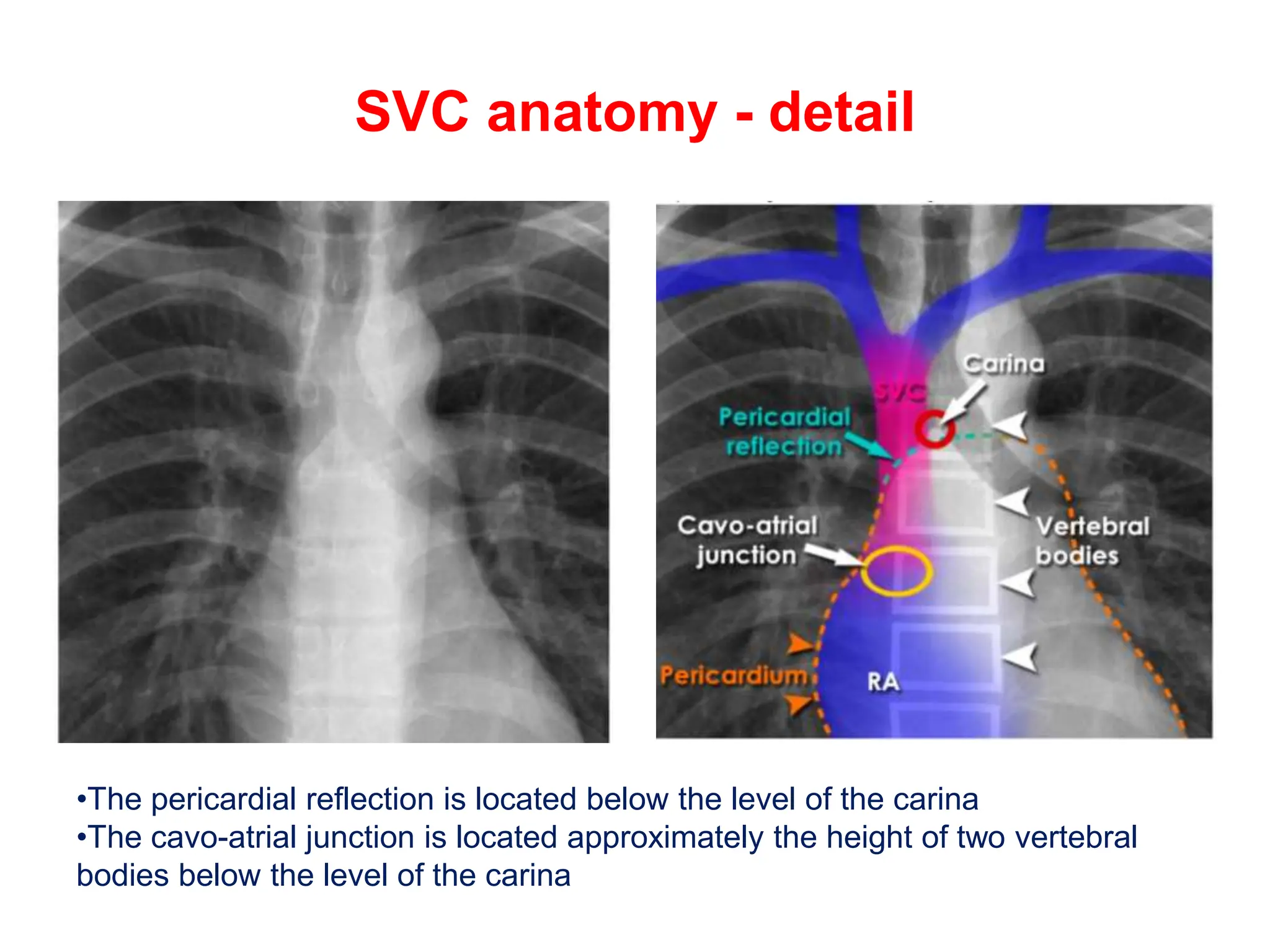 CHEST XRAY TUBES.pptx,,,,,,,,,,,,,,,,,,, | PPTX