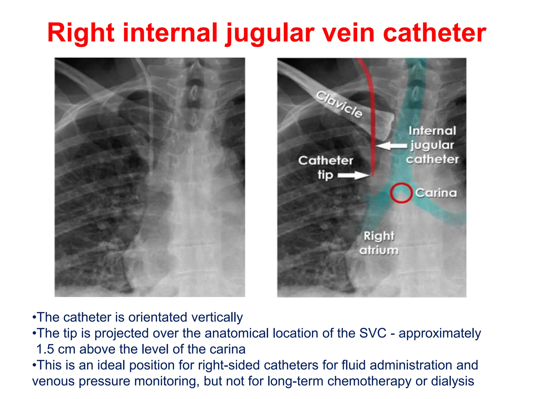 CHEST XRAY TUBES.pptx,,,,,,,,,,,,,,,,,,, | PPTX