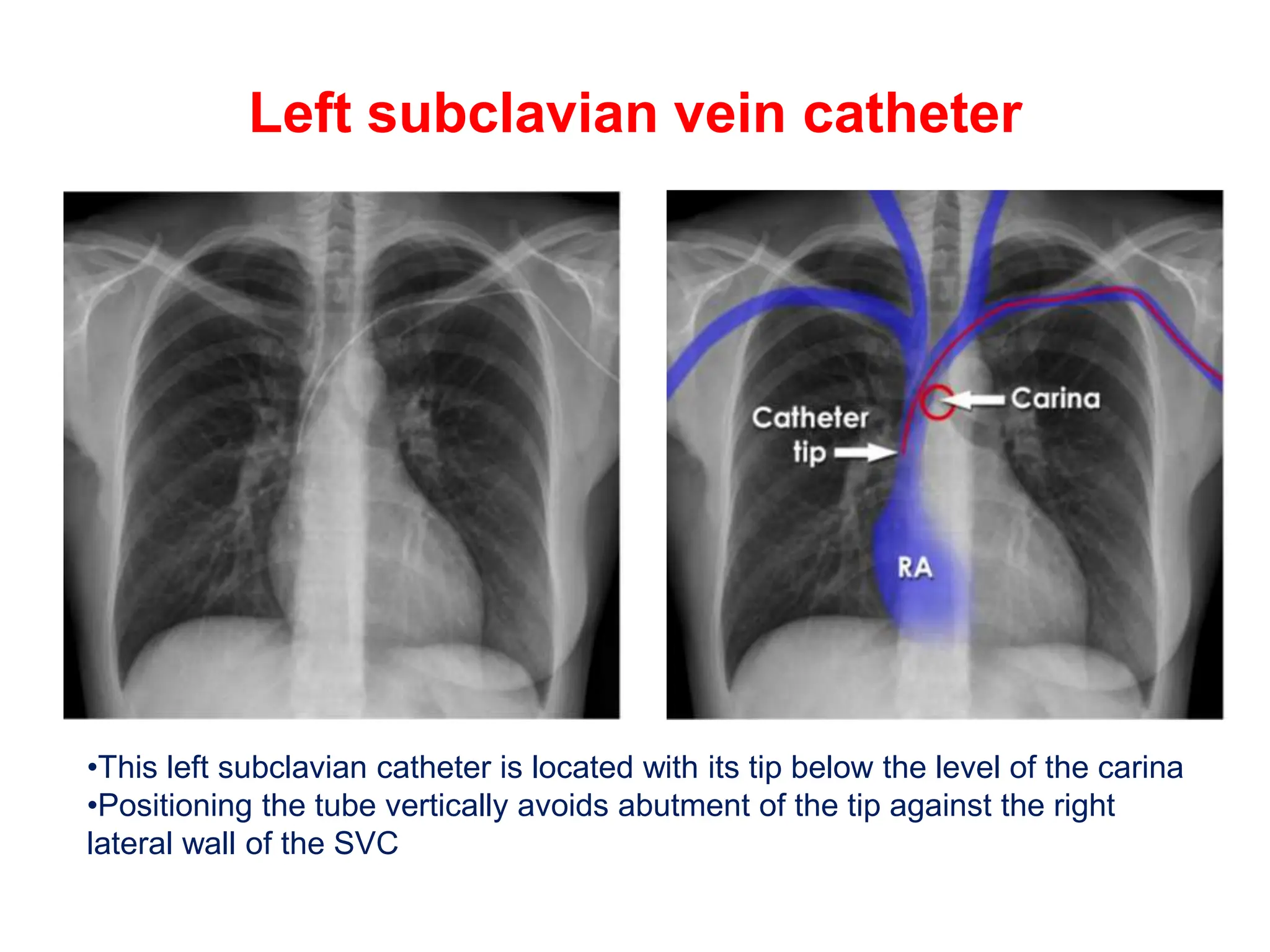 CHEST XRAY TUBES.pptx,,,,,,,,,,,,,,,,,,, | PPTX