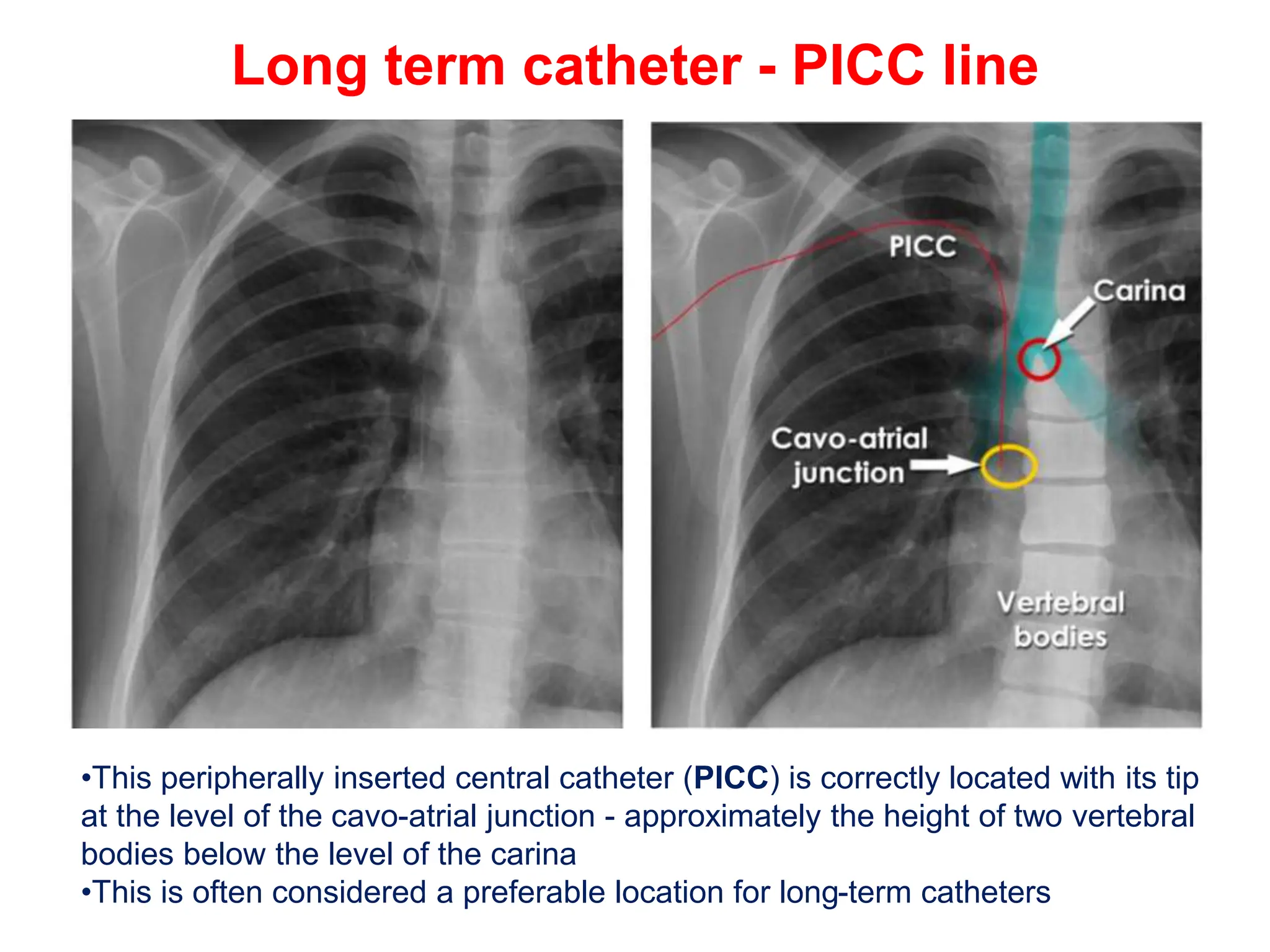 CHEST XRAY TUBES.pptx,,,,,,,,,,,,,,,,,,, | PPTX