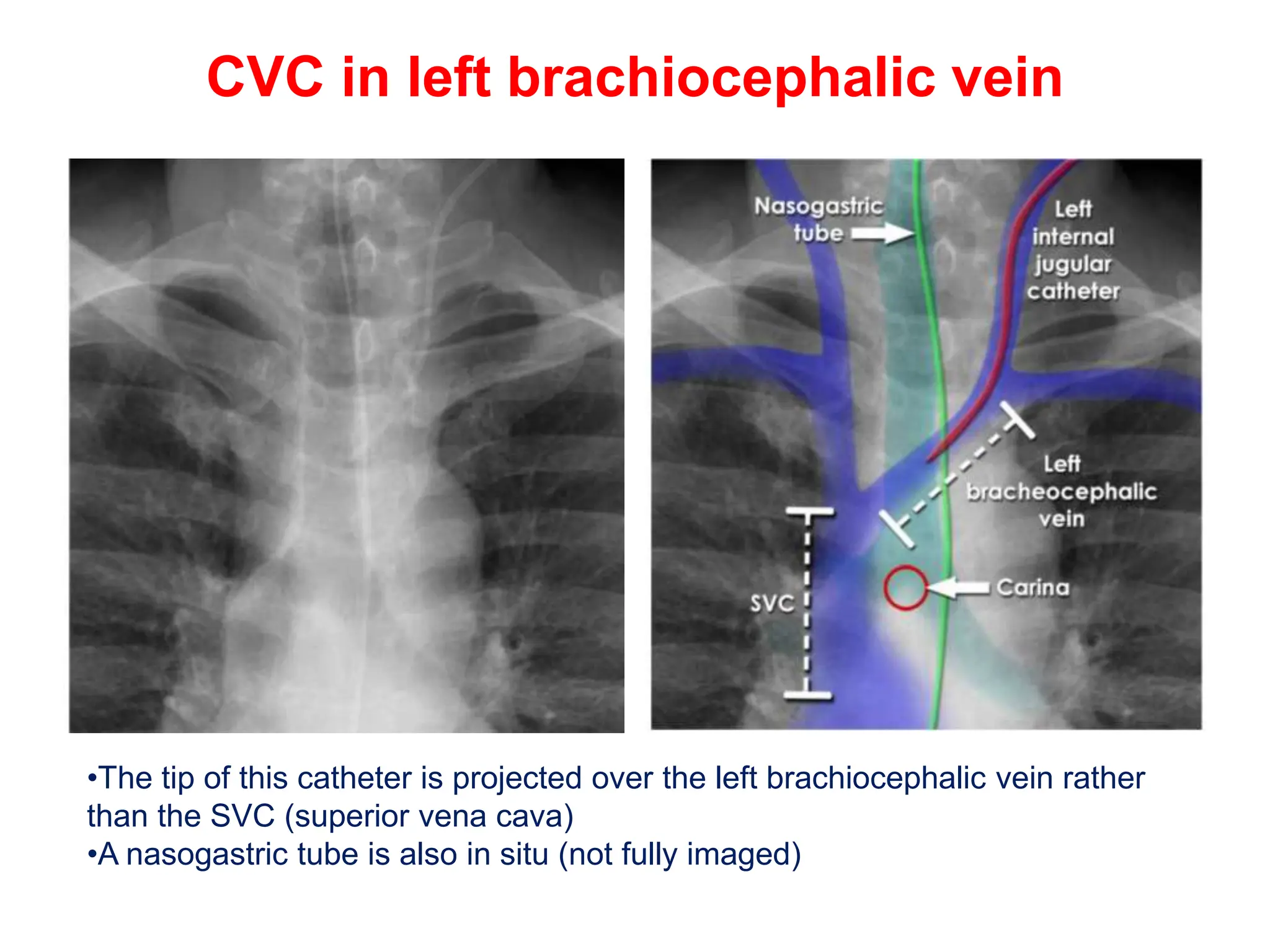 CHEST XRAY TUBES.pptx,,,,,,,,,,,,,,,,,,, | PPTX