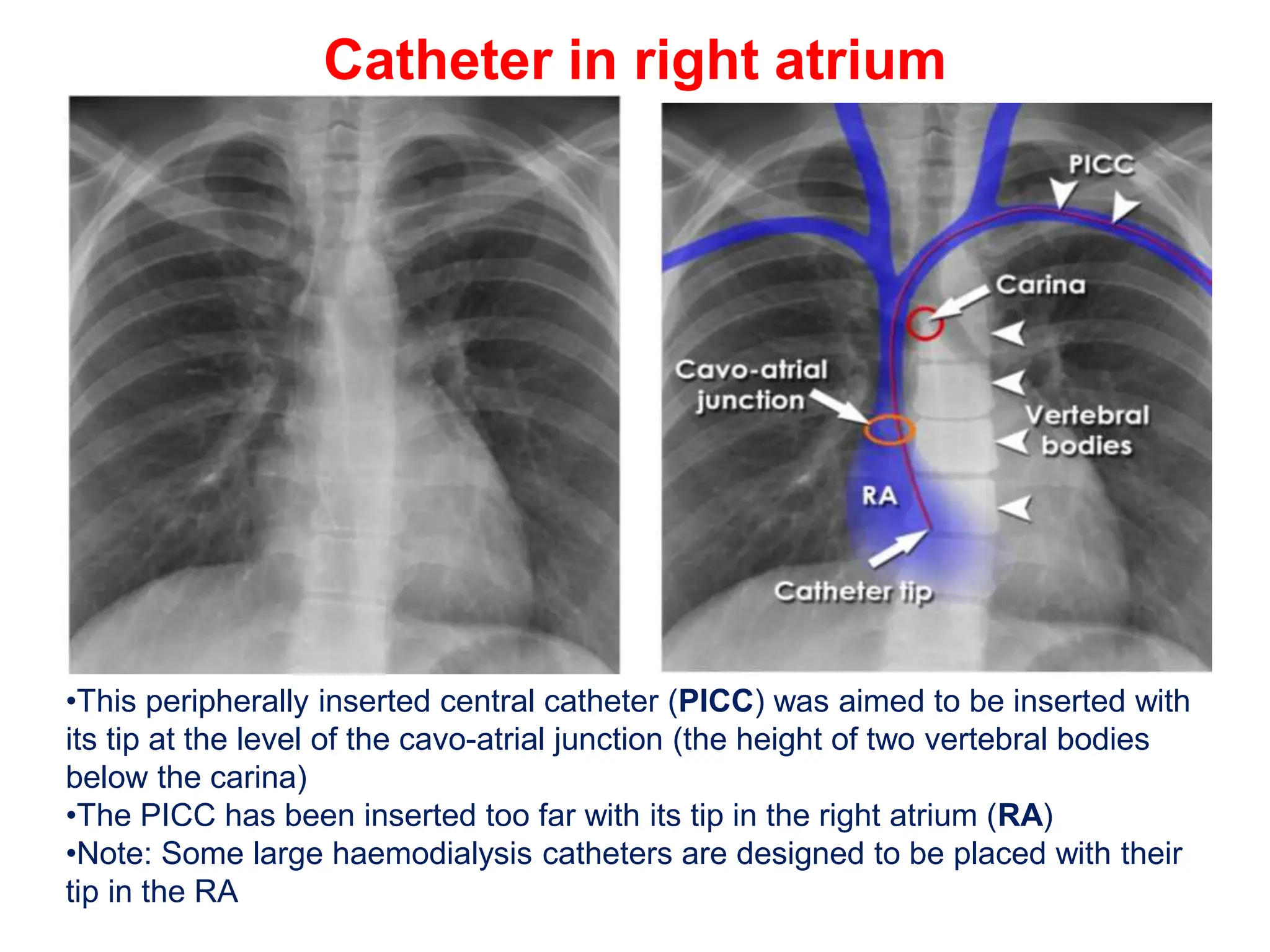 CHEST XRAY TUBES.pptx,,,,,,,,,,,,,,,,,,, | PPTX
