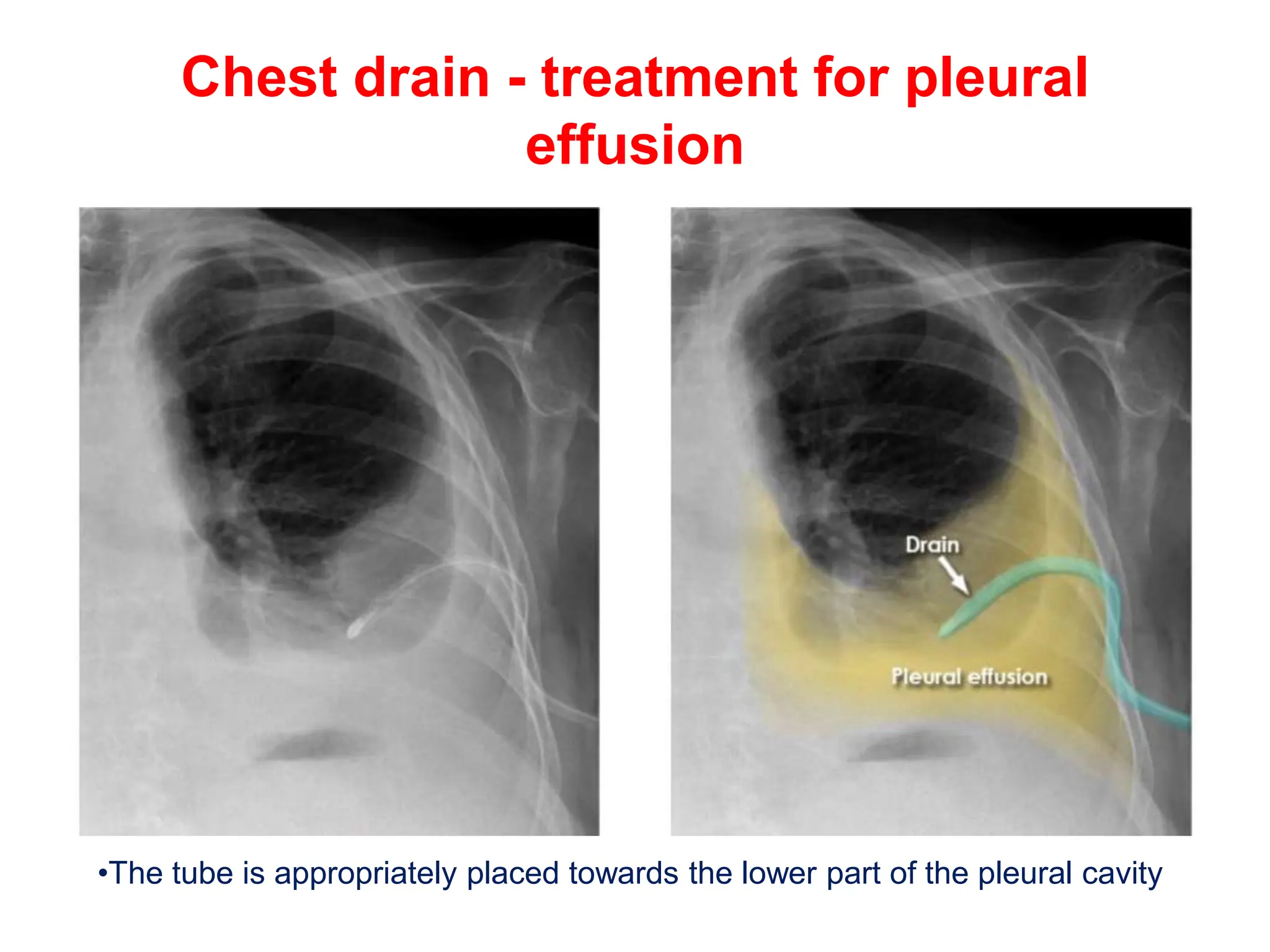 CHEST XRAY TUBES.pptx,,,,,,,,,,,,,,,,,,, | PPTX