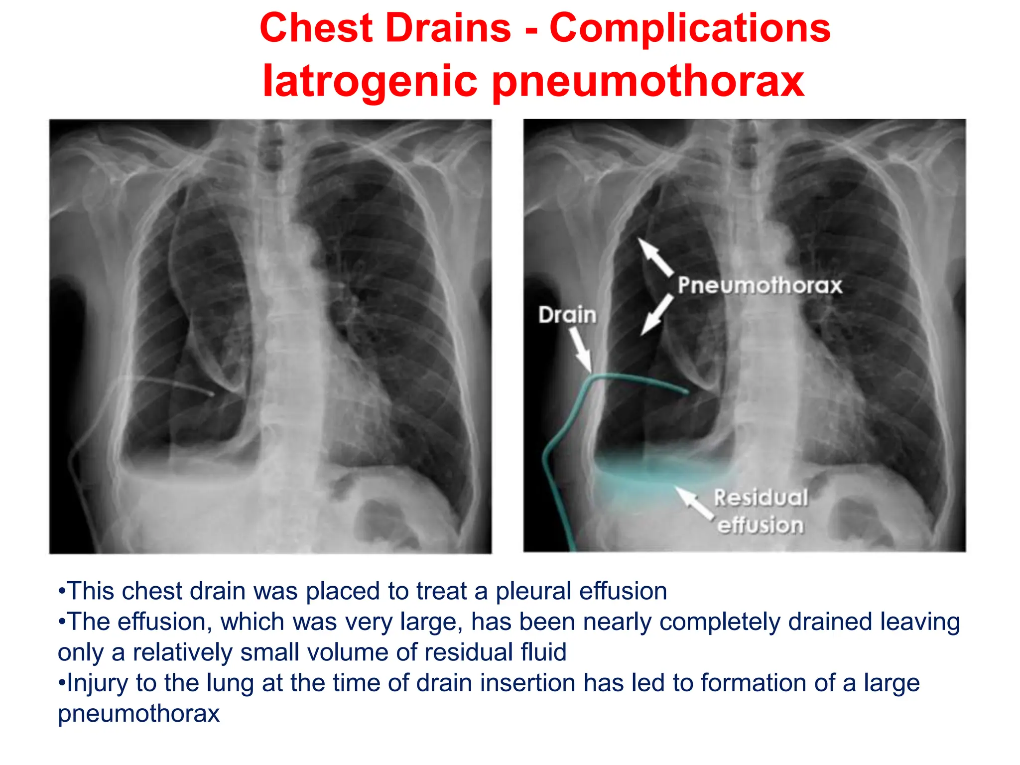 CHEST XRAY TUBES.pptx,,,,,,,,,,,,,,,,,,, | PPTX