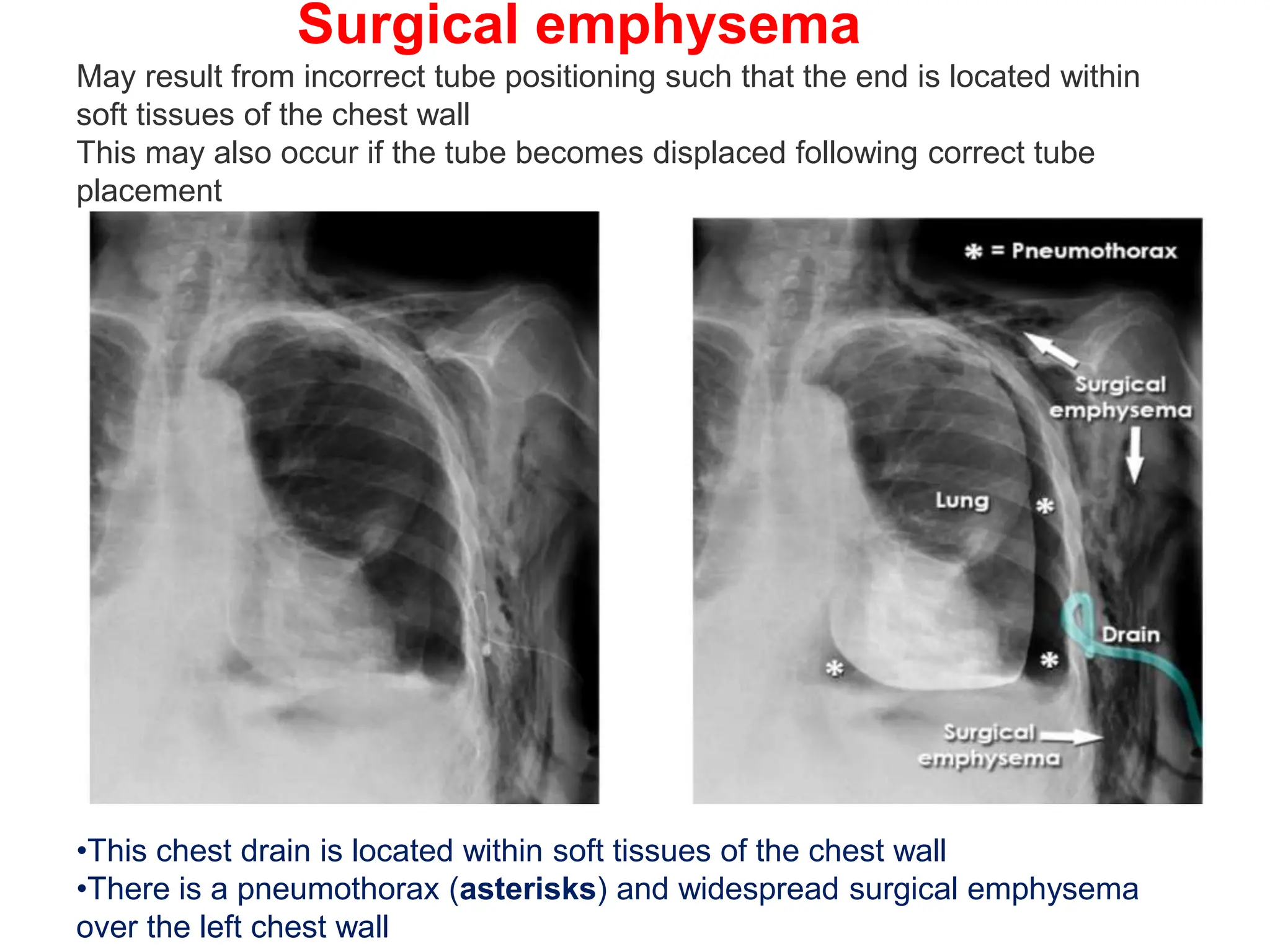 CHEST XRAY TUBES.pptx,,,,,,,,,,,,,,,,,,, | PPTX