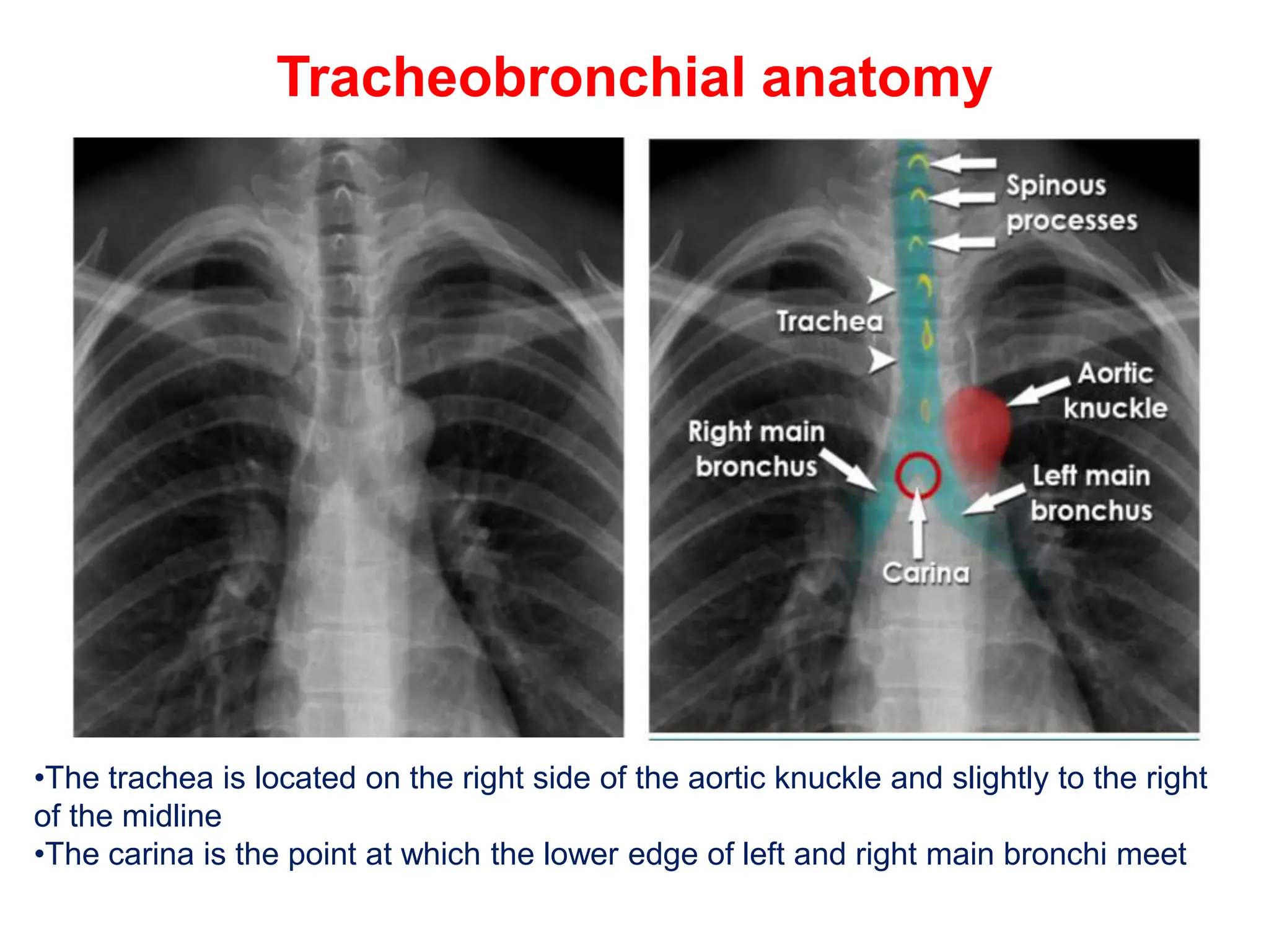 CHEST XRAY TUBES.pptx,,,,,,,,,,,,,,,,,,, | PPTX