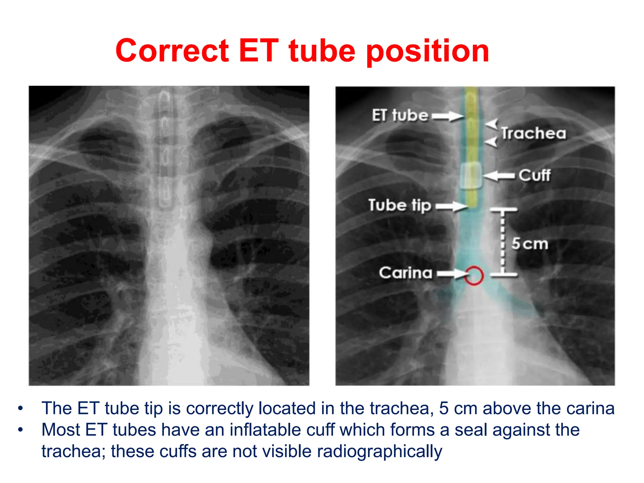 CHEST XRAY TUBES.pptx,,,,,,,,,,,,,,,,,,, | PPTX