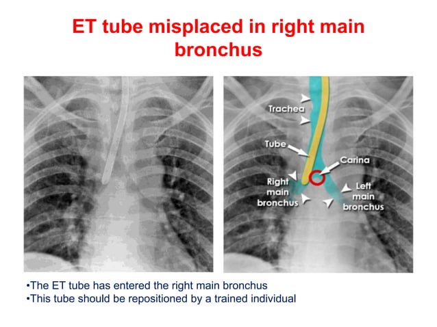 CHEST XRAY TUBES.pptx,,,,,,,,,,,,,,,,,,, | PPTX