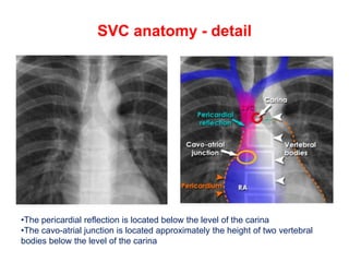 CHEST XRAY TUBES.pptx,,,,,,,,,,,,,,,,,,, | PPTX