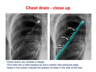 CHEST XRAY TUBES.pptx,,,,,,,,,,,,,,,,,,, | PPTX