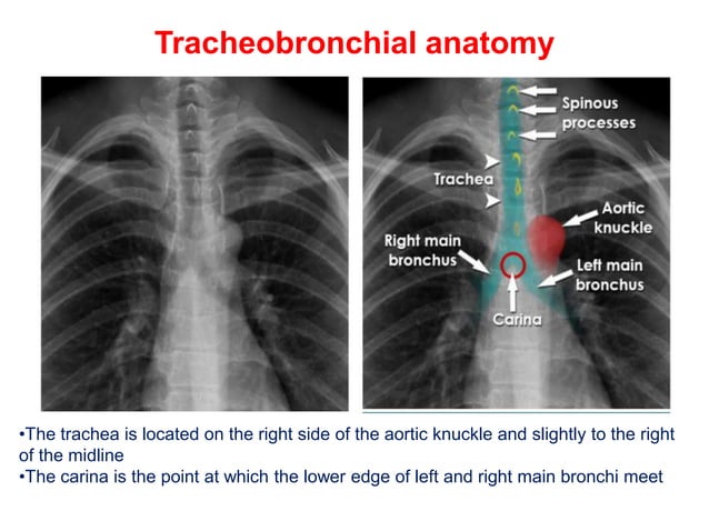 CHEST XRAY TUBES.pptx,,,,,,,,,,,,,,,,,,, | PPTX