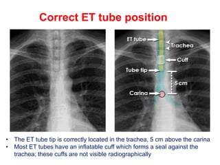 CHEST XRAY TUBES.pptx,,,,,,,,,,,,,,,,,,, | PPTX