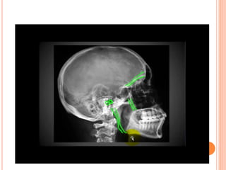 Xray views of skull1 | PPTX