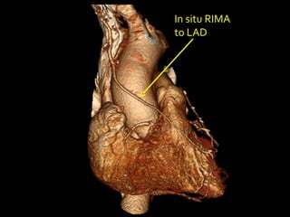 Invited Presentation: Hybrid coronary revascularization, ISMICS | PPT ...