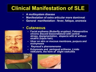 SYSTEMIC LUPUS ERITHEMATOSUS INTERACTIVE | PPT