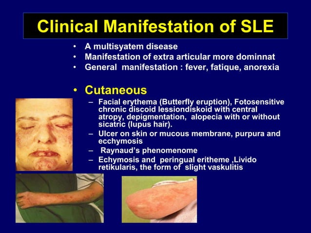 SYSTEMIC LUPUS ERITHEMATOSUS INTERACTIVE | PPT