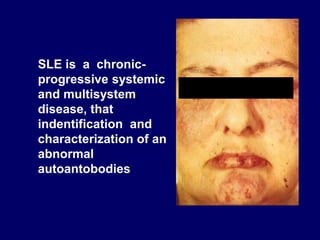 SYSTEMIC LUPUS ERITHEMATOSUS INTERACTIVE | PPT