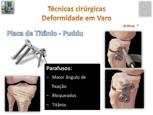 Osteotomia Valgizante do Joelho com Técnica de Puddu (Arthrex®) - Dav…
