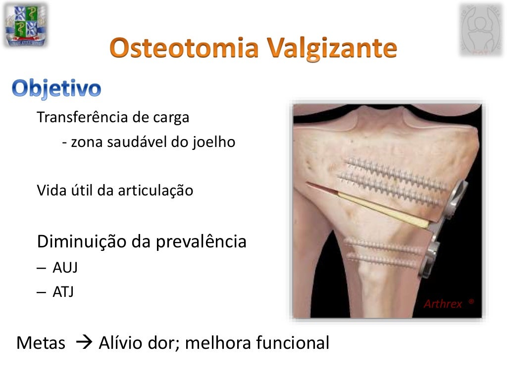 Osteotomia Valgizante do Joelho com Técnica de Puddu (Arthrex®) - Dav…