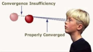 XT ( exotropia) | PPT