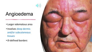 Dermatology Urticaria, Agioedema, Erythema Multiforme.pdf