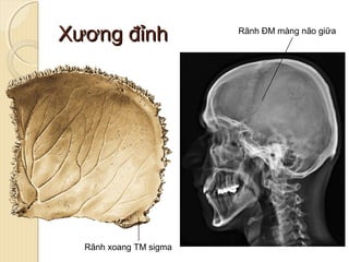 XƯƠNG ĐẦU MẶT | PPT