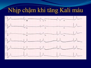 ĐIỆN TÂM ĐỒ TRONG RỐI LOẠN ĐIỆN GIẢI | PDF