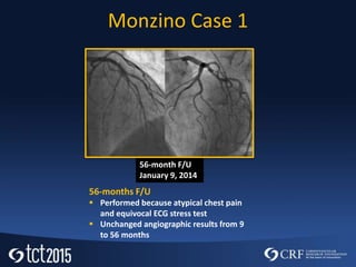 Stent Expansion and Lesion Coverage Insights From Intravascular Imaging ...