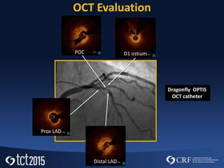 Stent Expansion and Lesion Coverage Insights From Intravascular Imaging ...