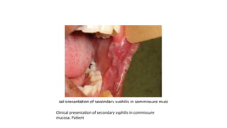 Syphilis: Oral Manifestations and Dental Considerations | PPT