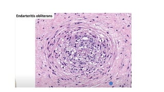 Syphilis: Oral Manifestations and Dental Considerations | PPT
