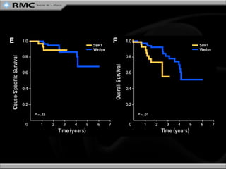 SBRT/SABR for Early Stage Lung Cancer: A Brief Overview | PPTX