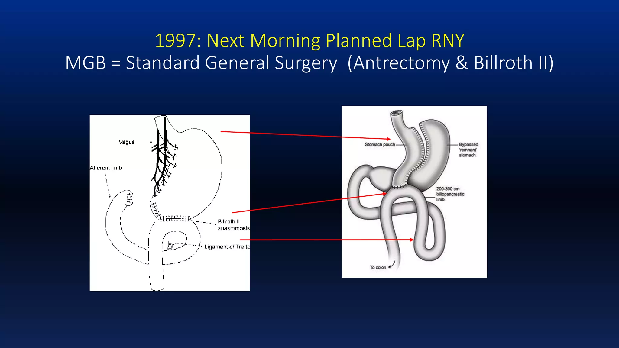 Dr Rutledge Introduction & Background Mini-Gastric Bypass | PPTX