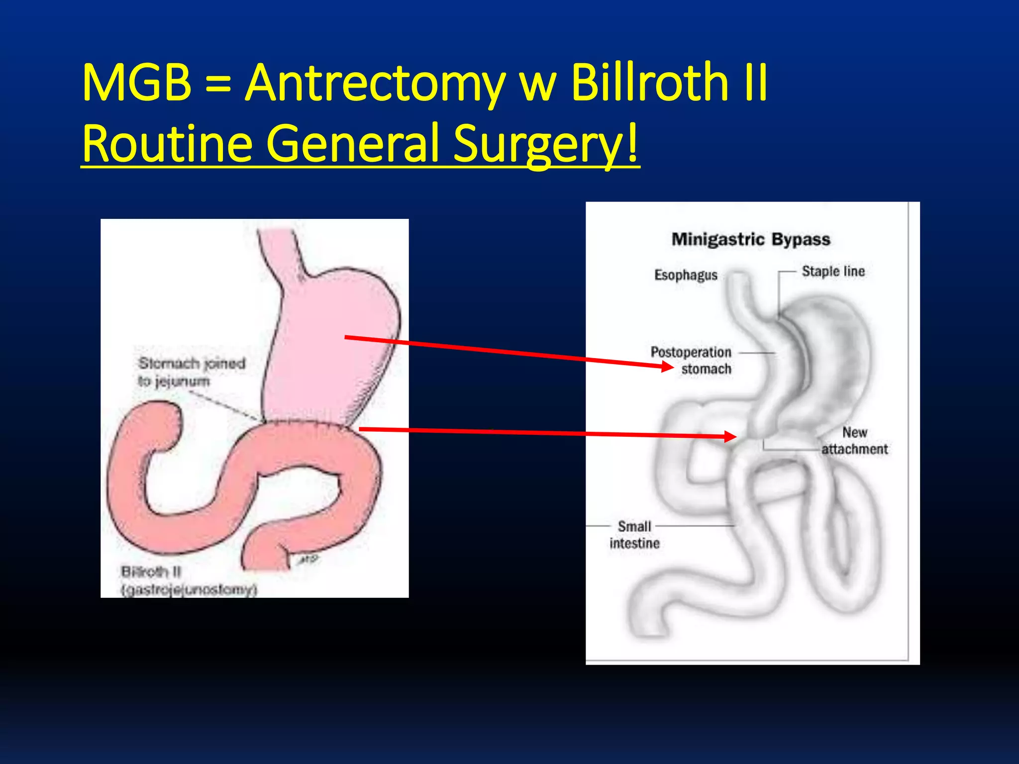 Intro to Mini-Gastric Bypass (Dr Rutledge) Why? + MGB v Sleeve | PPTX