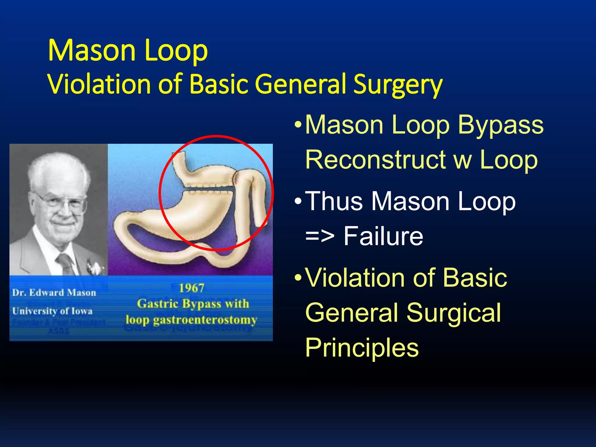 Intro to Mini-Gastric Bypass (Dr Rutledge) Why? + MGB v Sleeve | PPTX