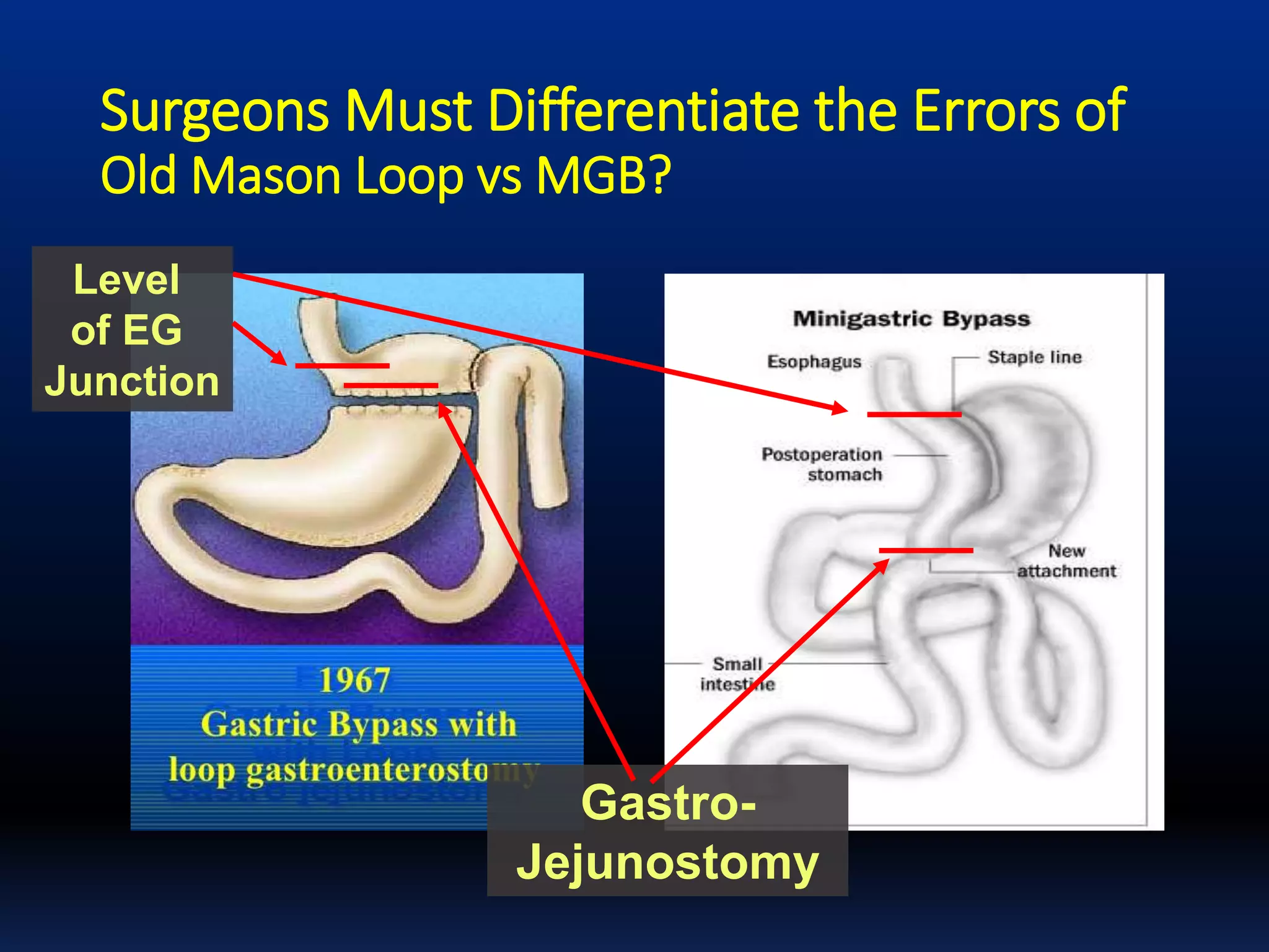 Intro to Mini-Gastric Bypass (Dr Rutledge) Why? + MGB v Sleeve | PPTX